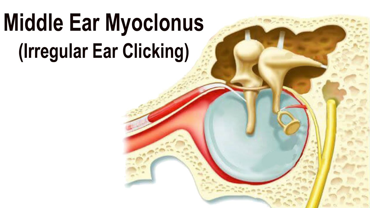 Botox For Tinnitus Relief: A Promising Treatment?